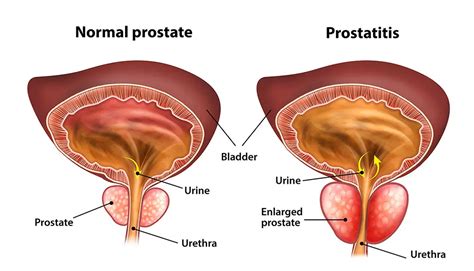 Can An Enlarged Prostate Cause Erectile Dysfunction