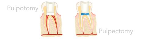 Pulpotomy Vs Pulpectomy My Dental Key