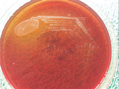 Bacteremia Caused By Comamonas Testosteroni An Unusual Pathogen