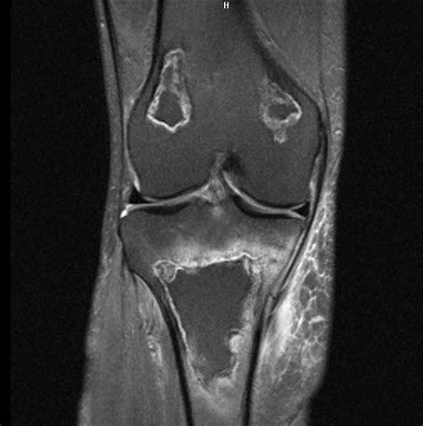 Pain In The Tibia And Multiple Bone Lesions