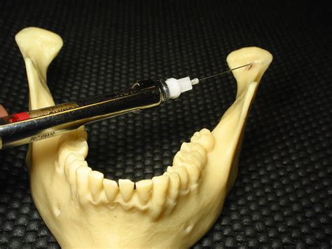 Dental Mandibular Block Technique At Edward Bailey Blog