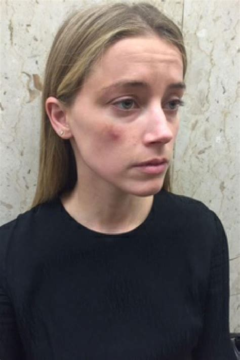 Amber Heard Defends Her Op Ed Shares Bruised Photos