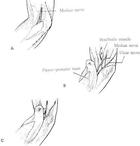 Get Eip To Epl Tendon Transfer Gif