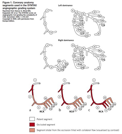 What Is The Syntax Score And How Should We Use It