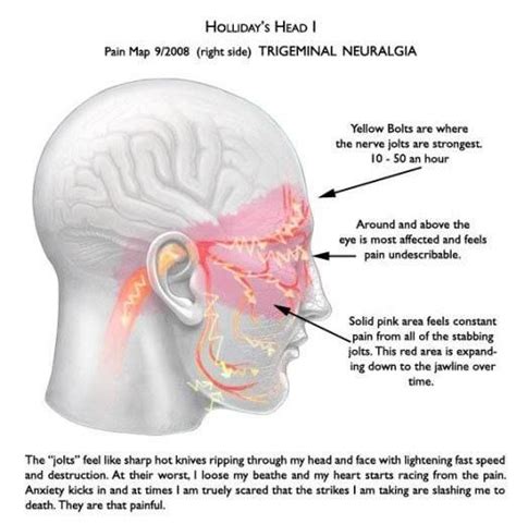 1000 Images About What Is Trigeminal Neuralgia On Pinterest The Ojays Felt And Branches