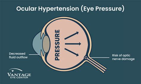 Ocular Hypertension What Are The Causes And How To Reduce It