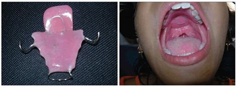 Obturator For Cleft Palate