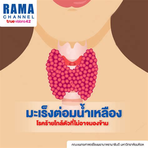 มะเร็งต่อม Cancer Care You มะเร็งดูแลได้ง่ายกว่าที่คิด