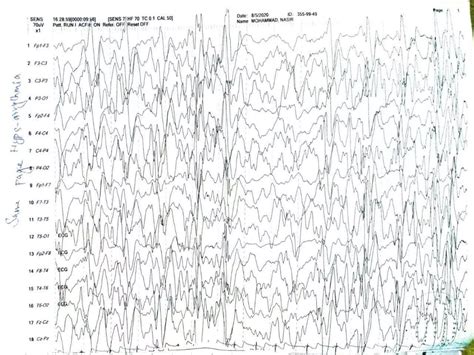 Abnormal Eeg Patterns Pptx Brain And Nervous System Disorders Diseases And Conditions