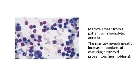 Hemolytic Disorders Due To Inherited Abnormalities In Red Cell