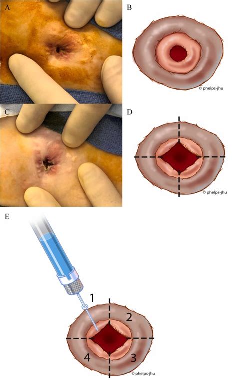 Stomal Stenosis After Continent Urinary Diversion In Bladder Exstrophy