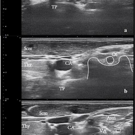 Sonographic Structures At Distinct Cervical Level A In Plane Download Scientific Diagram