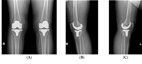 Figure 2 From Can A Total Knee System Providing 1 Mm Increment Of