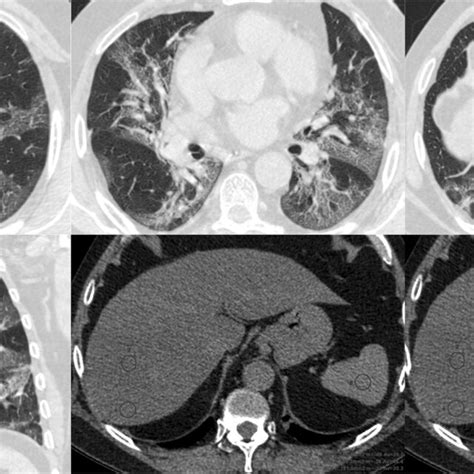 Chest Ct Severity Score And Ctls Non‐enhanced Ct Images In A 57