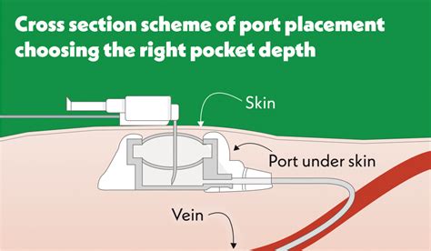 Porta Catheter Placement