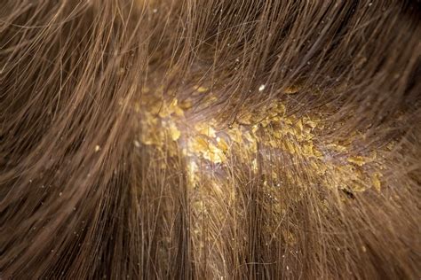 Galvos Niežėjimas Pleiskanos Grožio Klubas