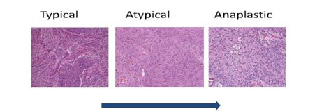 Histopathological Progression Of Meningiomas From Grade I Typical To