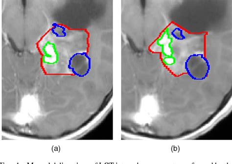 Figure 1 From Semiautomatic Segmentation And Follow Up Of