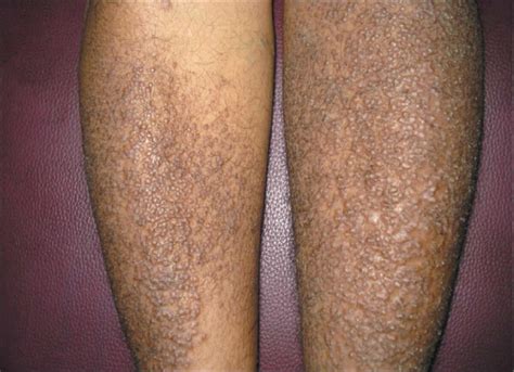Amyloidosis
