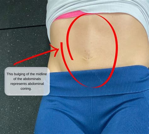 Abdominal Exercises Rectus Diastasis At Carisa Macaulay Blog