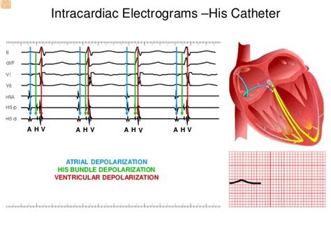 Intracardiac Electrograms