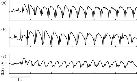 Absence Seizure Eeg