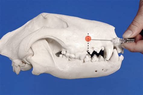 Infraorbital Nerve Block