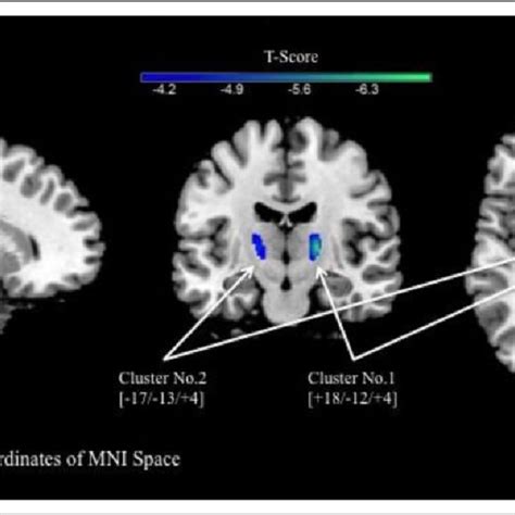 Vbm Of Thalamus Vbm Voxel Based Morphometry Download Scientific
