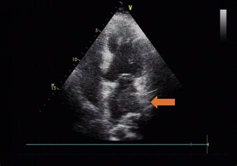 Hyperechoic Lumpy Mass Detected On Transthoracic Echocardiography
