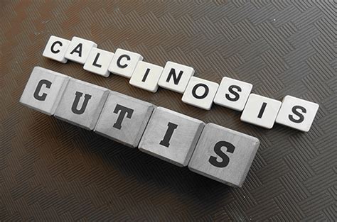 Adakah Cara Mencegah Calcinosis Cutis Ini Faktanya