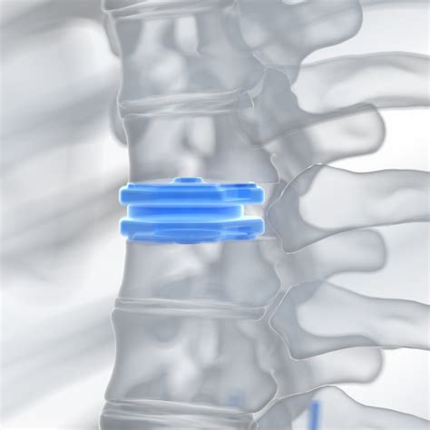 How Is An Artificial Disc Replacement Performed New Jersey Comprehensive Spine Care