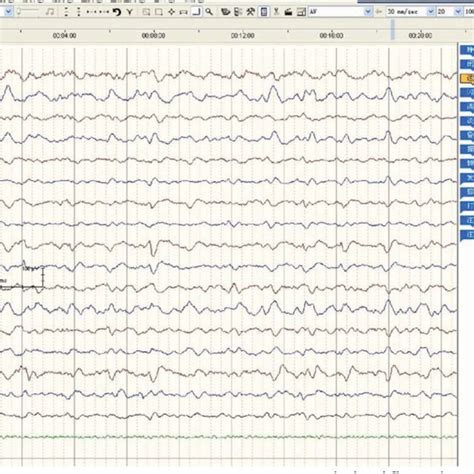Sharp Slow Complex Waves In The First Eeg Download Scientific Diagram