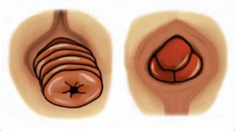 Rectal Prolapse Vs Hemorrhoid