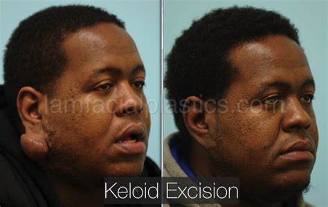 Keloids Dallas Cosmetic Skin Procedures Plano TX