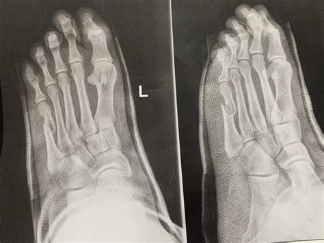 5th Metatarsal Fracture Over The Month I Guess Its Healing At An