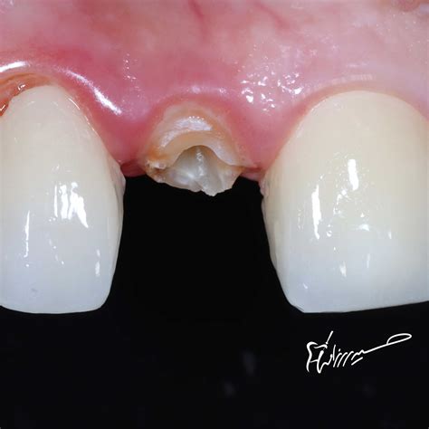 Saving Failed Zirconia Crown With New Emax Crown Myzerodonto