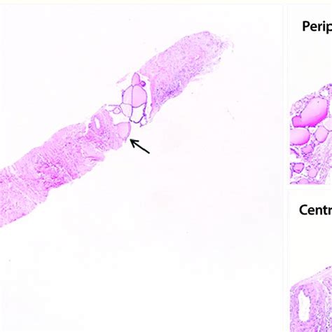 Orientation Of The Thyroid Core Needle Biopsy A Normal Thyroid Download Scientific Diagram