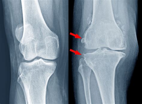 Arthrosamid Knee Injection Frequently Asked Questions Faqs In 2026