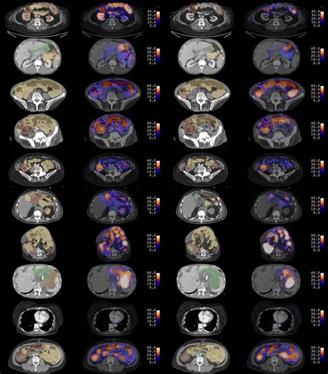 Examples Of CNN Predictions In Test Subjects Each Row Corresponds Download Scientific