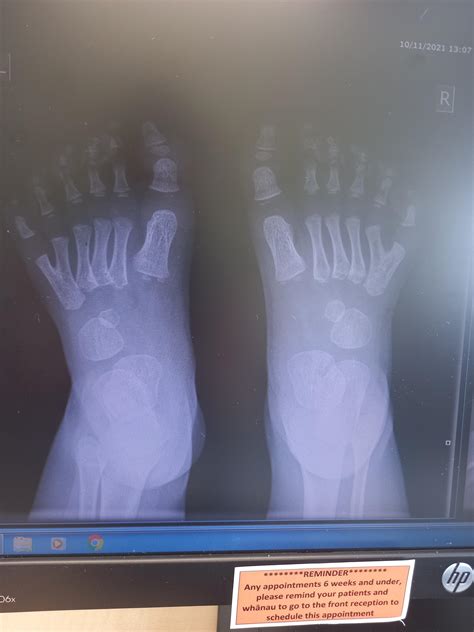 While We Are Sharing Extra Digits This Is My Sons Xray Rradiology