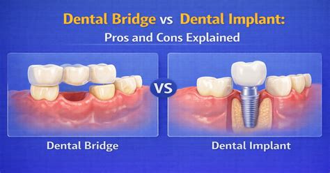 Dental Bridge Vs Dental Implant Pros And Cons Explained