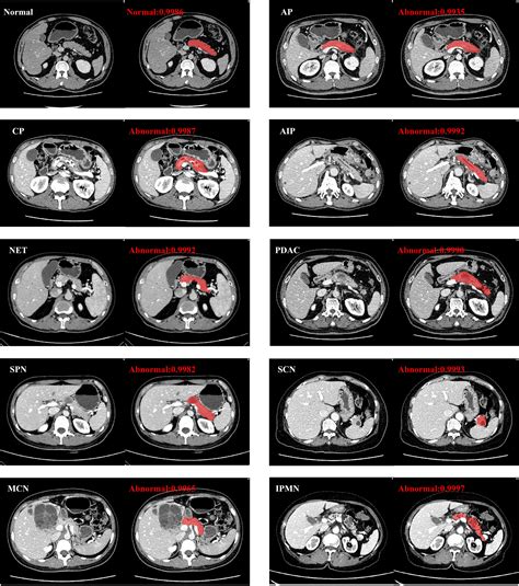 Label Free Differentiation Of Pancreatic Pathologies From Normal