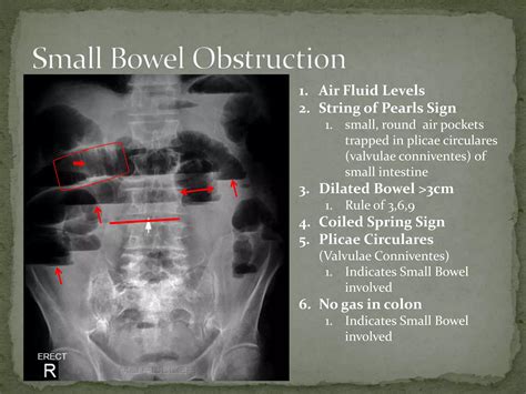 Small Bowel Obstruction 1 Pptx