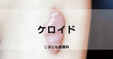 ケロイド｜こばとも皮膚科｜栄駅（名古屋市栄区）徒歩2分