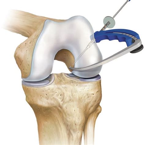 Femoral Socket Creation Source Copyright Arthrex Naples Fl