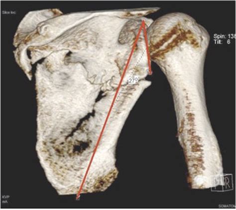 Is Radiograph Glenopolar Angle Accurate For Extraarticular Scapular