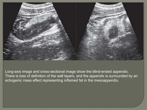 Acute Abdomen Sonographic Findings Ppt Pptx Pregnancy Reproductive Health