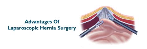 Laparoscopic Hernia Surgery Benefits And Complications
