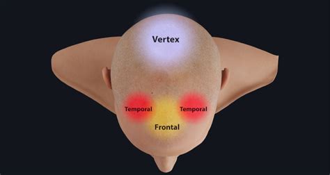 The Facts On Pattern Baldness Complete Anatomy