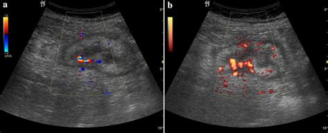 Ultrasound Diagnosis Of Typhlitis Pmc